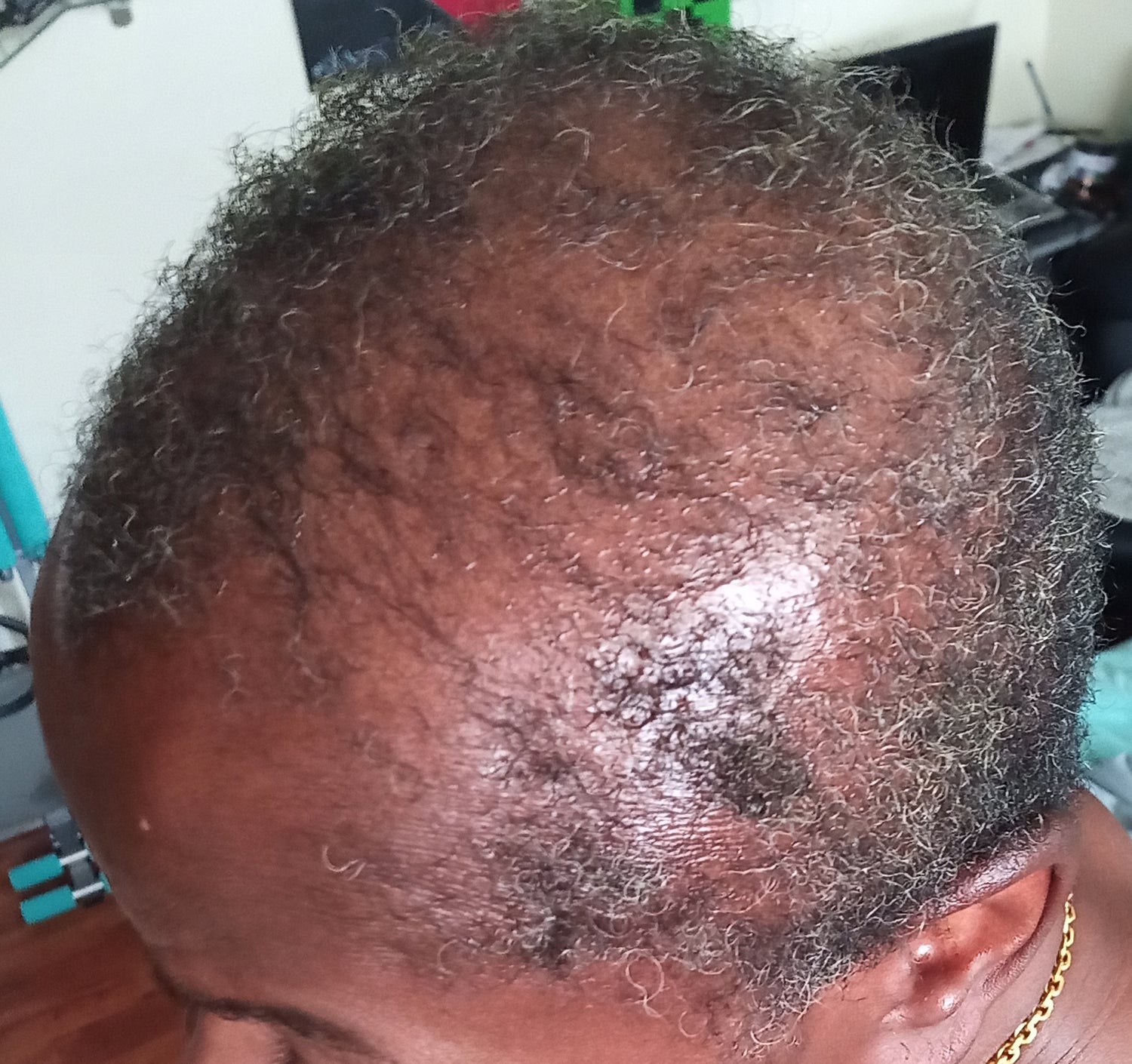 2ddr | Best Product For Hair Loss | 2 Deoxy D Ribose 2ddr Gel