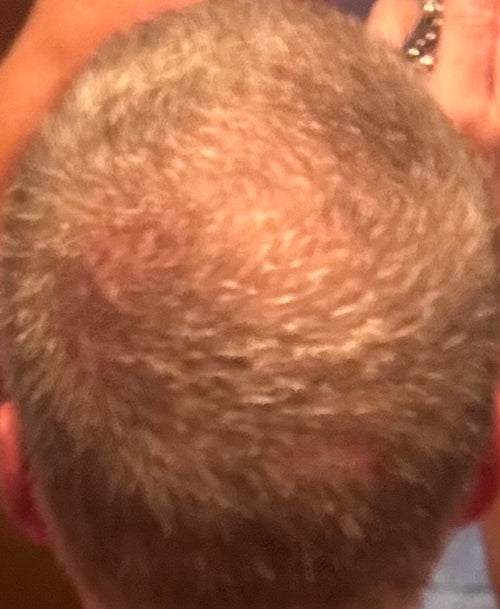 Hair Care Products with 2-deoxy-D-ribose | 2dDR For Hair Loss