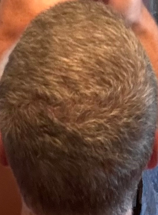 Hair Care Products with 2-deoxy-D-ribose | 2dDR For Hair Loss