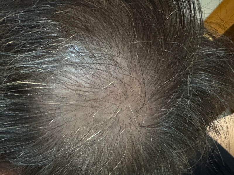 Hair Care Products with 2-deoxy-D-ribose | 2dDR For Hair Loss