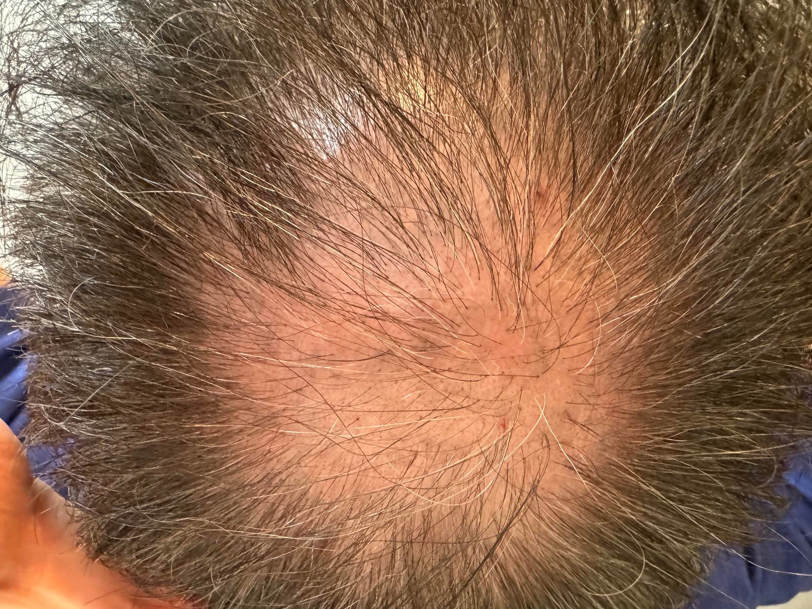 2ddr | Best Product For Hair Loss | 2 Deoxy D Ribose 2ddr Gel